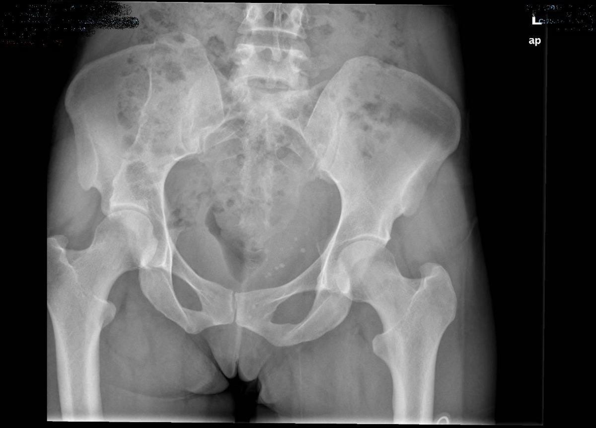 Trauma pelvico : Guías y clasificación WSES 2017. | Urgencias de Poniente